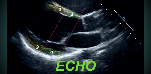 LEARN THE FULL TTE ECHO ULTRASOUND PROTOCOL DEMO for PC - How to ...