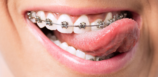 Braces Photo Editor Beauty for PC - How to Install on Windows PC, Mac