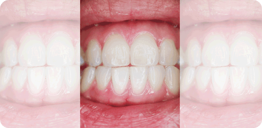 How To Stop Bleeding Gums for PC - How to Install on Windows PC, Mac