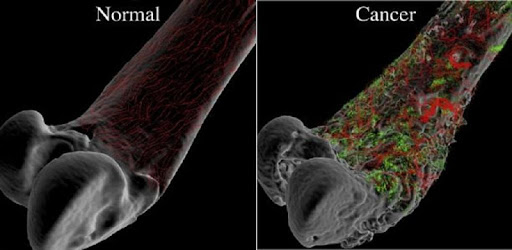 Bone cancer for PC - How to Install on Windows PC, Mac
